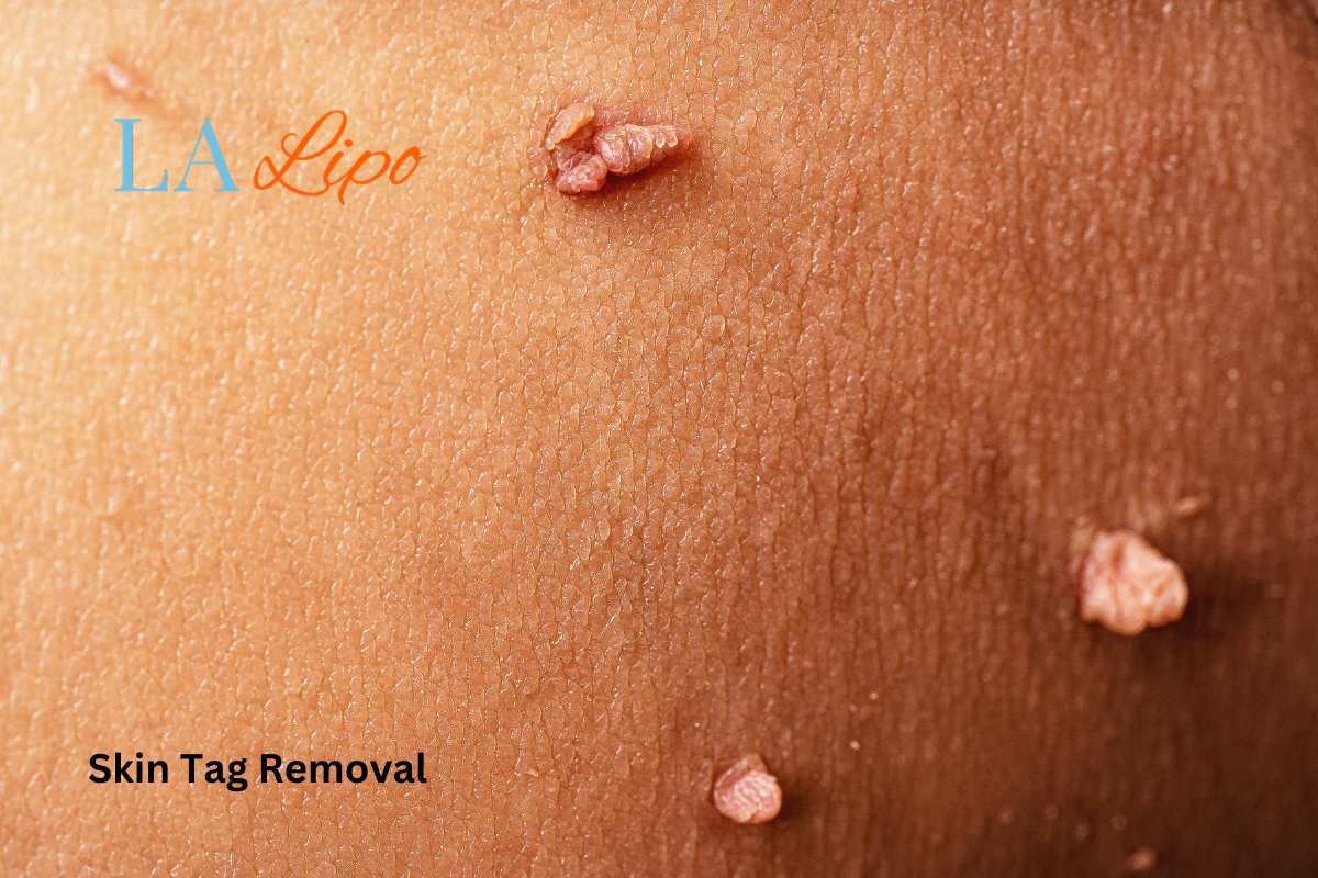 What Does Skin Look After Skin Tag Removal Newcastle upon Tyne